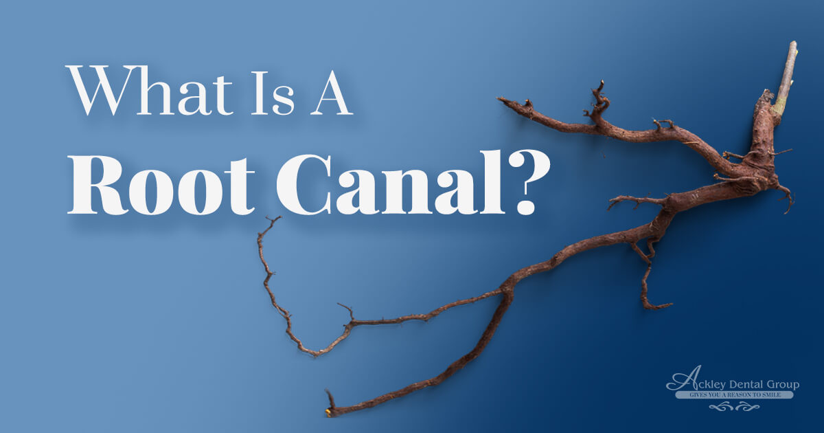 Root Canal Therapy - Ackley Dental Group